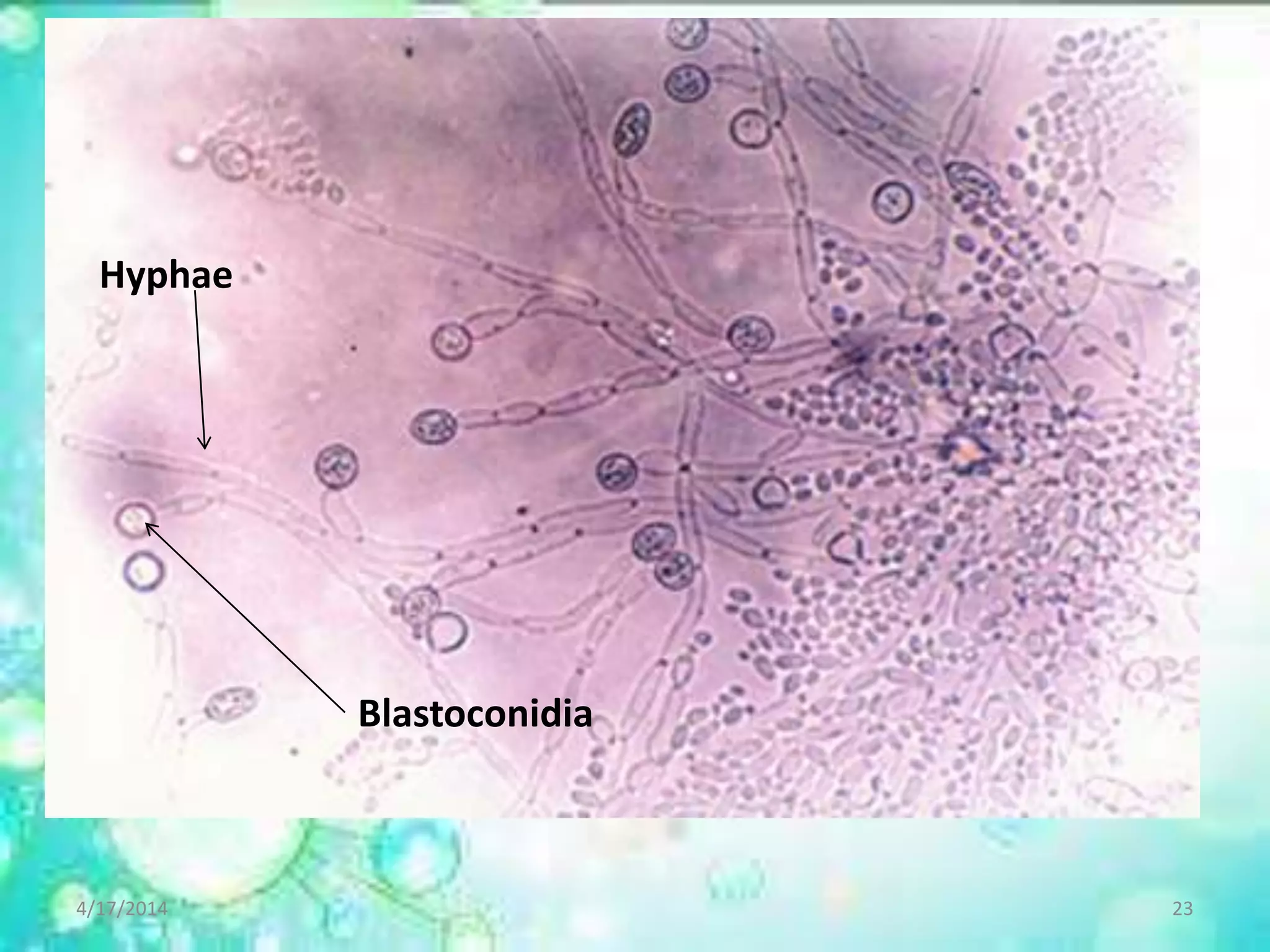 Candidiasis, Moniliasis, Oral thrush, Yeast infections | PPT