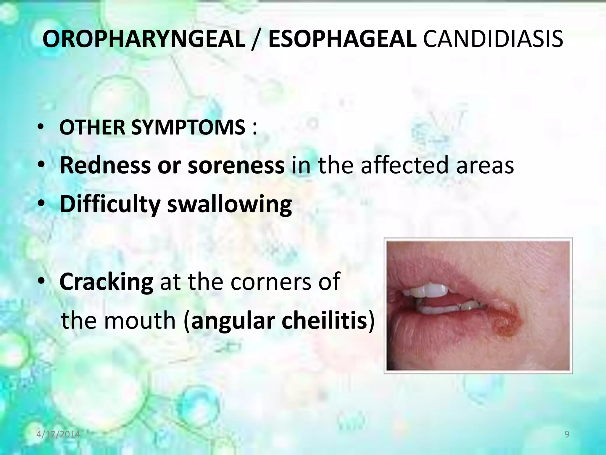 Candidiasis, Moniliasis, Oral thrush, Yeast infections | PPT