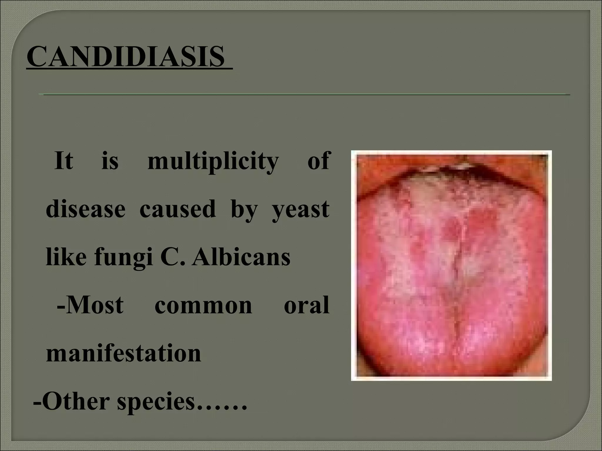 Candidiasis: Most common oppotunistic infection | PPT