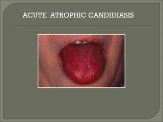 Candidiasis: Most common oppotunistic infection | PPT