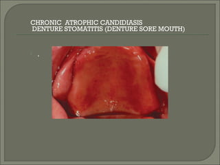 Candidiasis: Most common oppotunistic infection | PPT