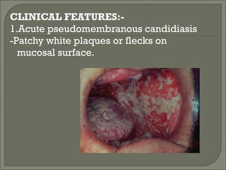 Candidiasis: Most common oppotunistic infection | PPT