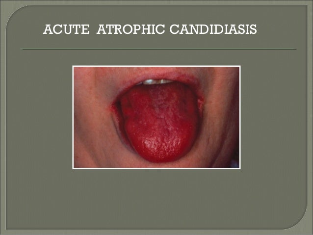 Candidiasis: Most common oppotunistic infection