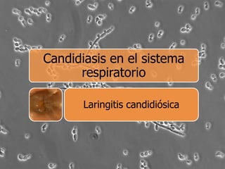 Candidiasis | PPTX