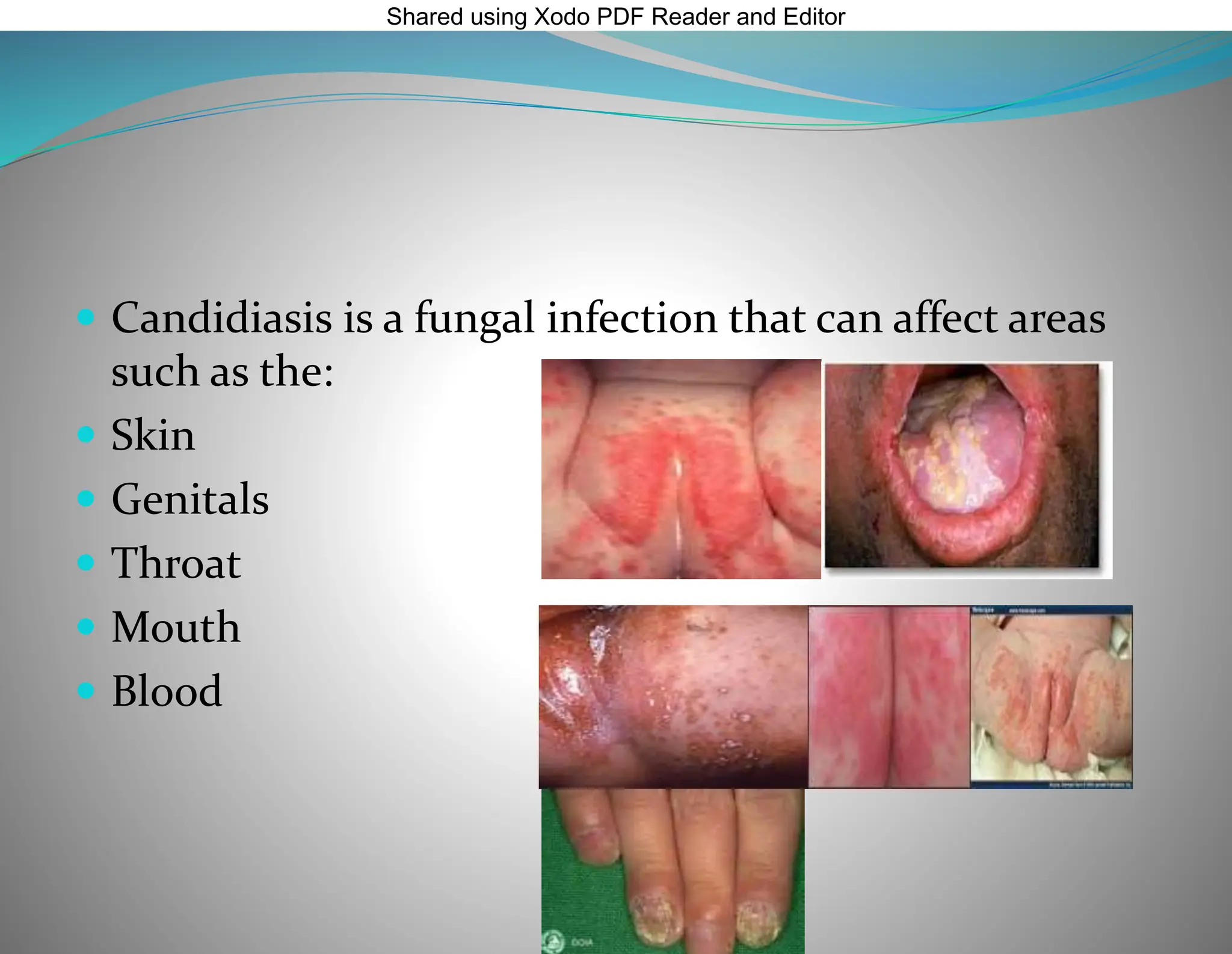 candidiasis-150323115911-conversion-gate01.pdf
