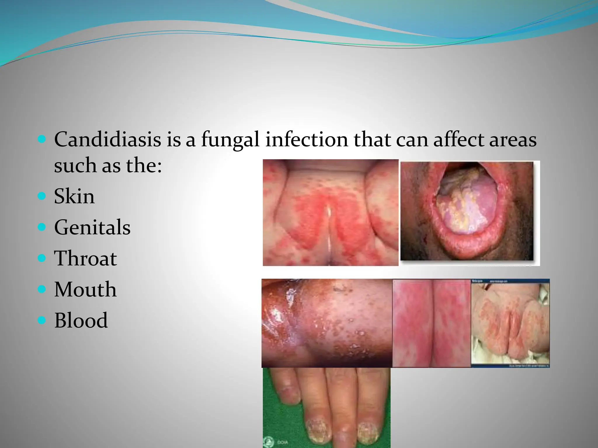 candidiasis-150323115911-conversion-gate01 (1).pdf