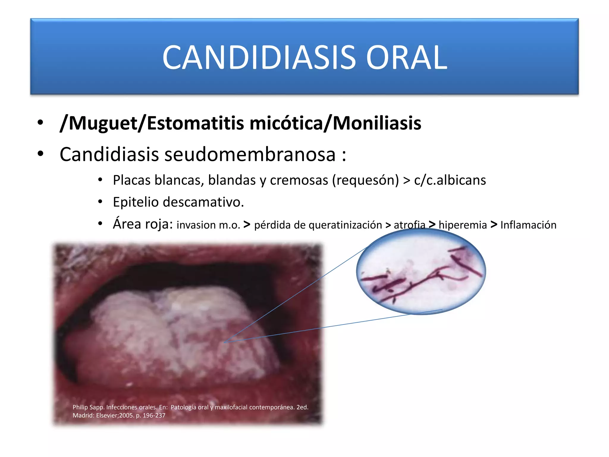 Candidiasis Oral | PPTX