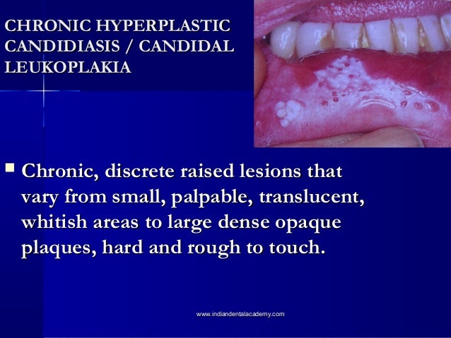 Candidiasis /cosmetic dentistry courses