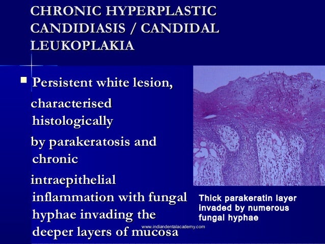 Chronic Hyperplastic Candidiasis Histology Gastrointestinal