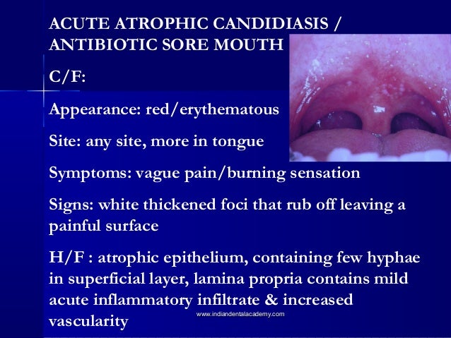 Candidiasis /cosmetic dentistry courses