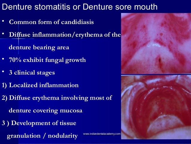 Candidiasis /cosmetic dentistry courses