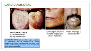 Candidiasis | PPTX
