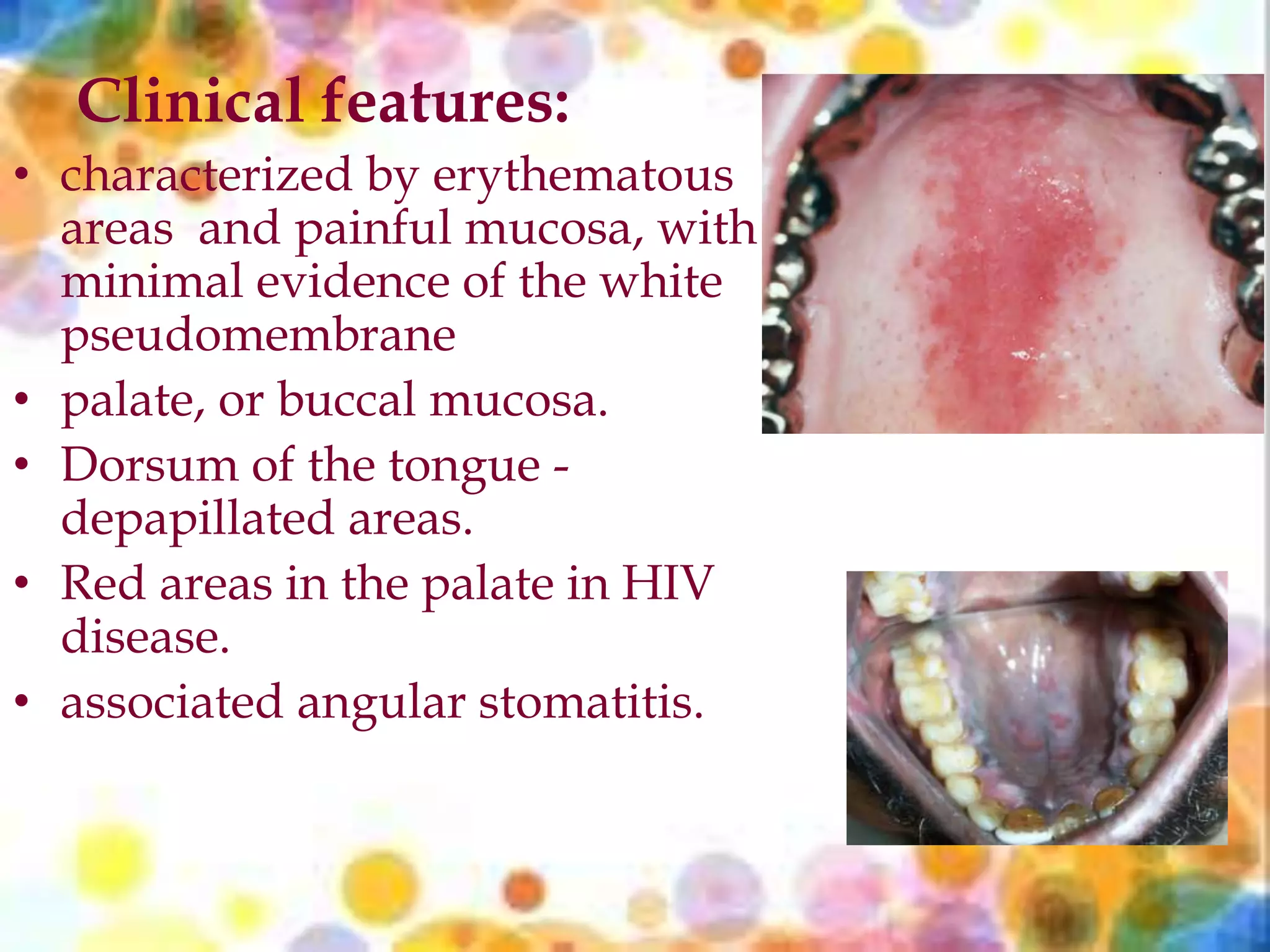 Candidiasis | PPTX