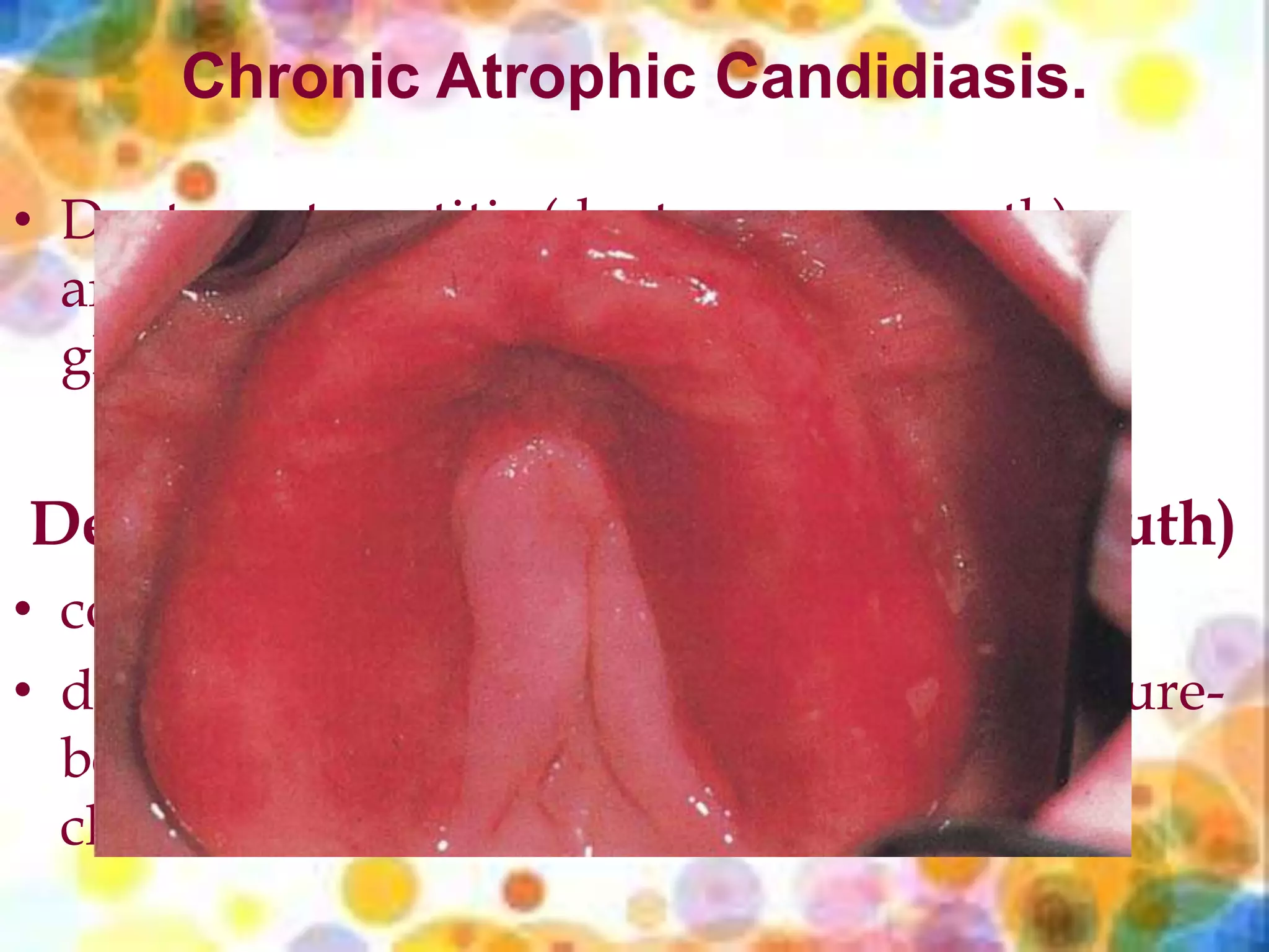 Candidiasis | PPTX