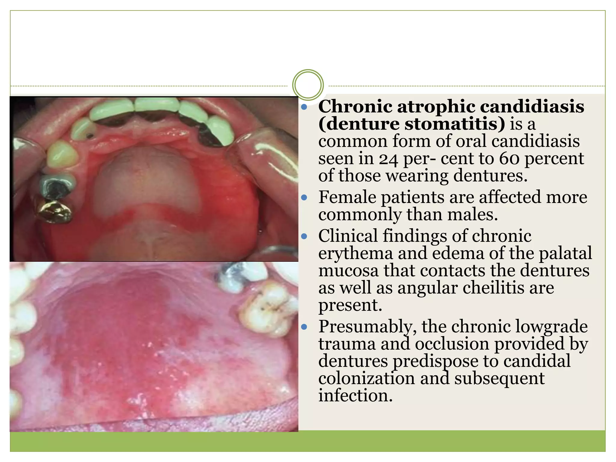 Candidiasis | PPTX