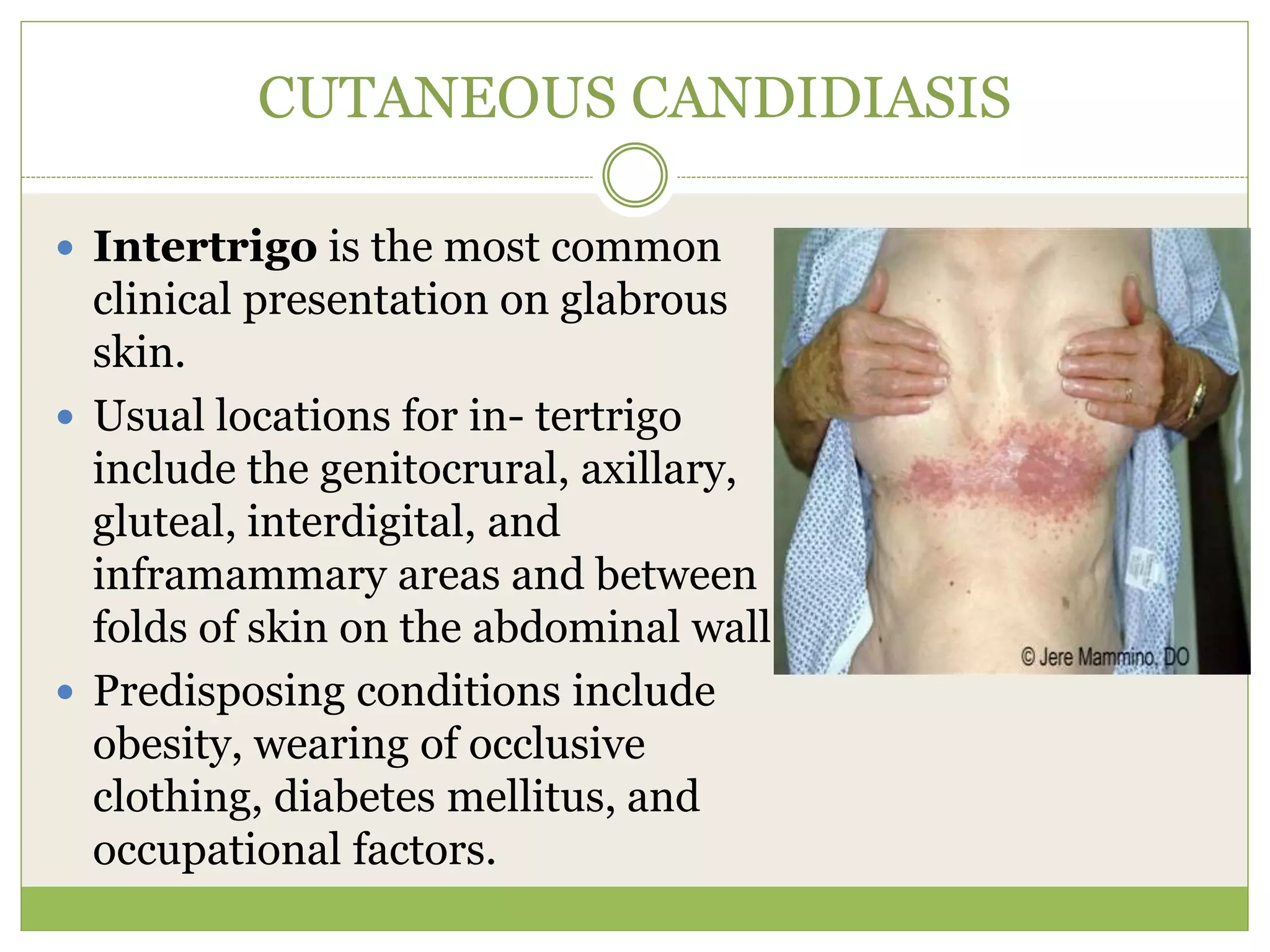 Candidiasis | PPTX