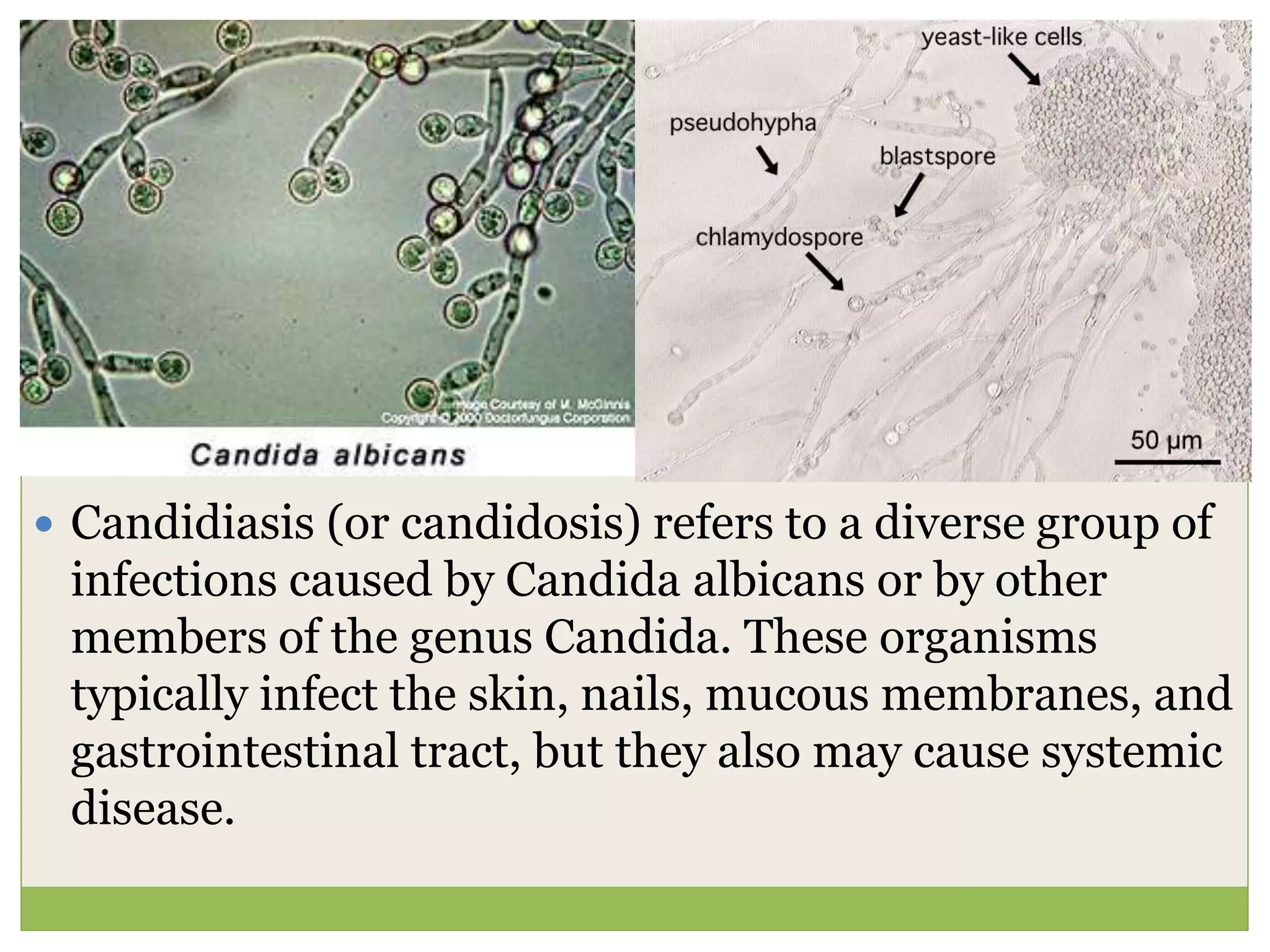 Candidiasis | PPTX