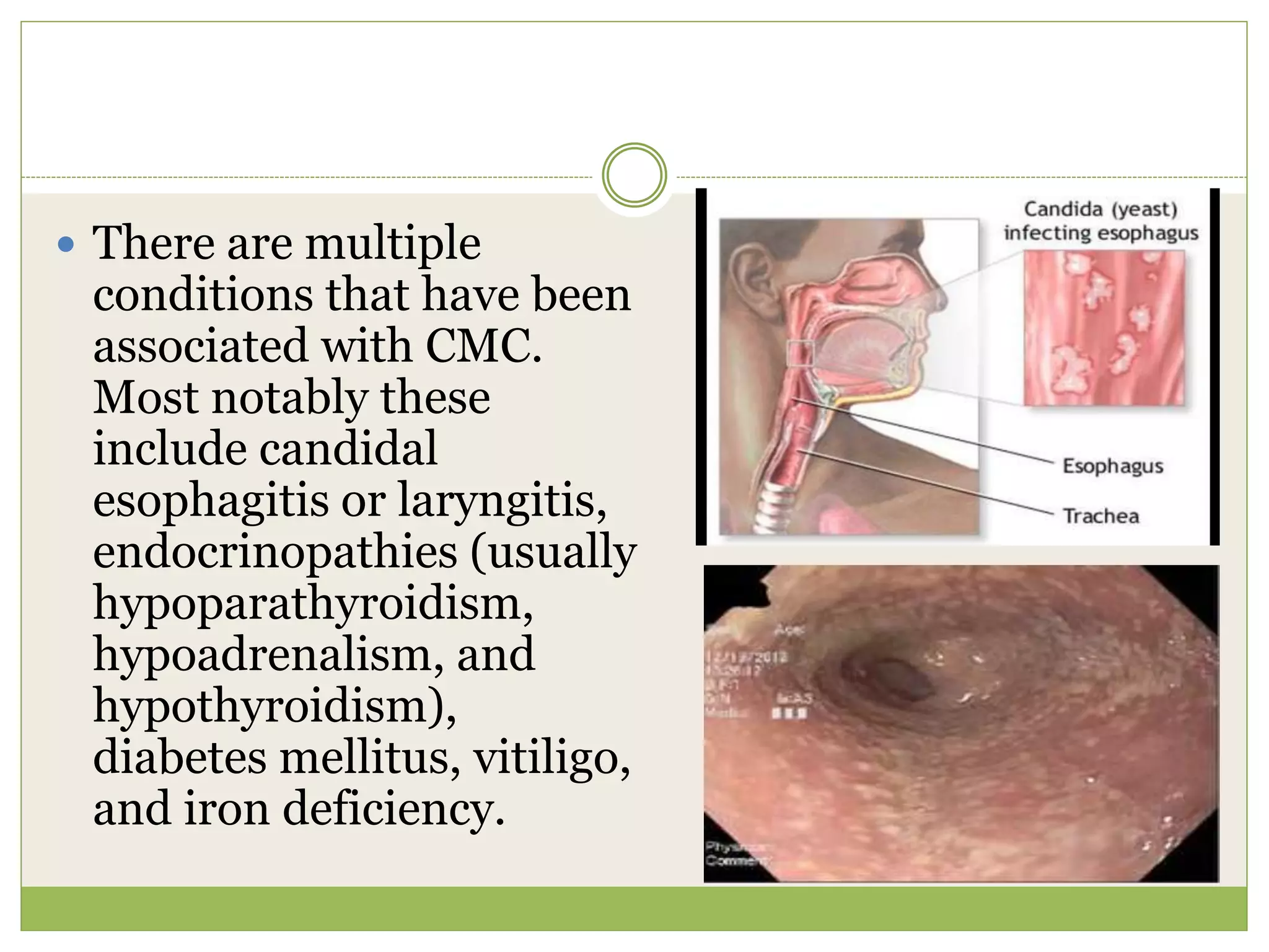 Candidiasis | PPTX