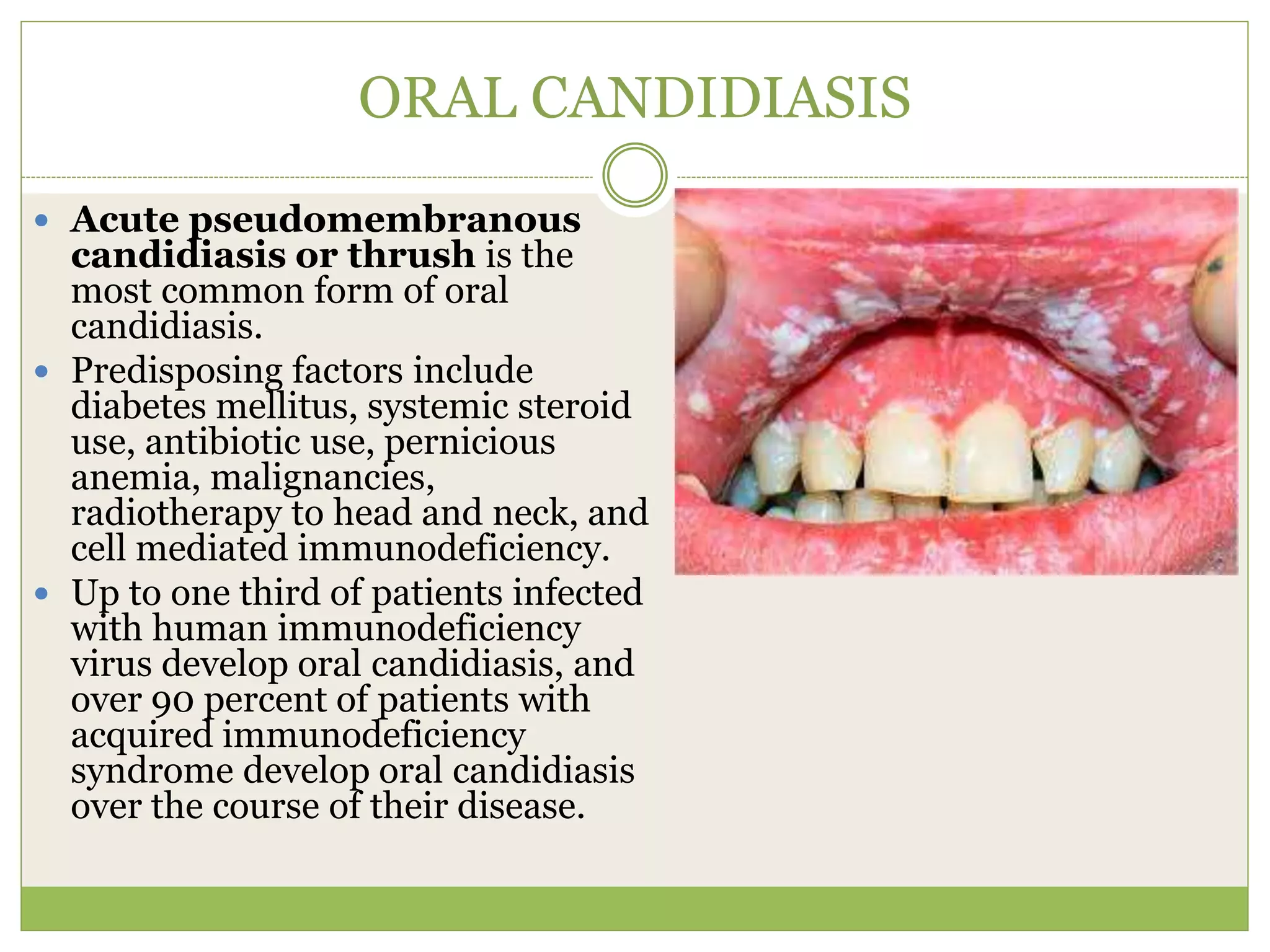 Candidiasis | PPTX