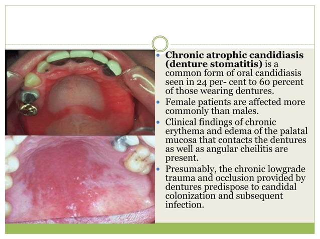 Candidiasis | PPTX