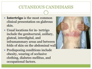 Candidiasis | PPTX