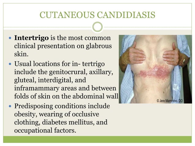 Candidiasis | PPT