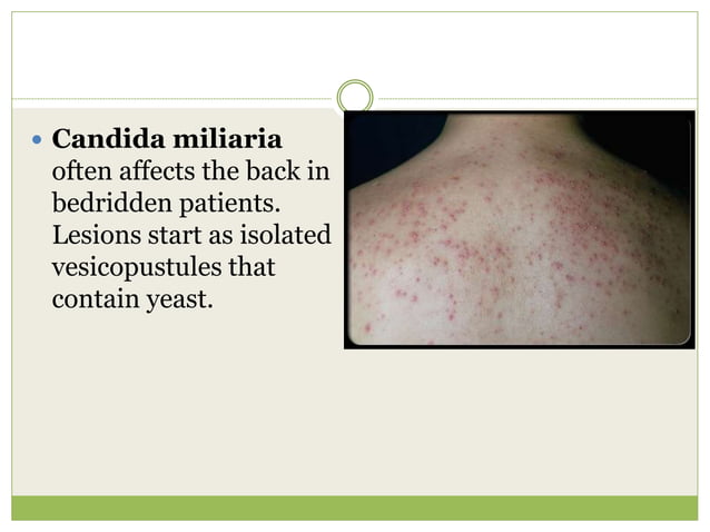 Candidiasis | PPTX