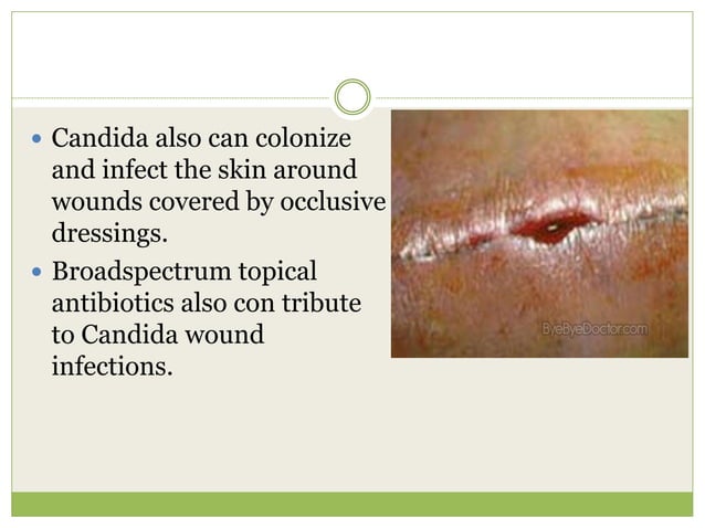 Candidiasis | PPTX