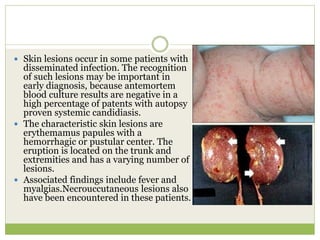 Candidiasis | PPTX