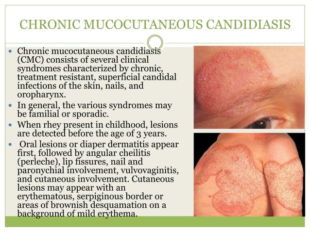 Candidiasis | PPTX