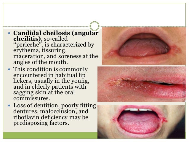 Candidiasis
