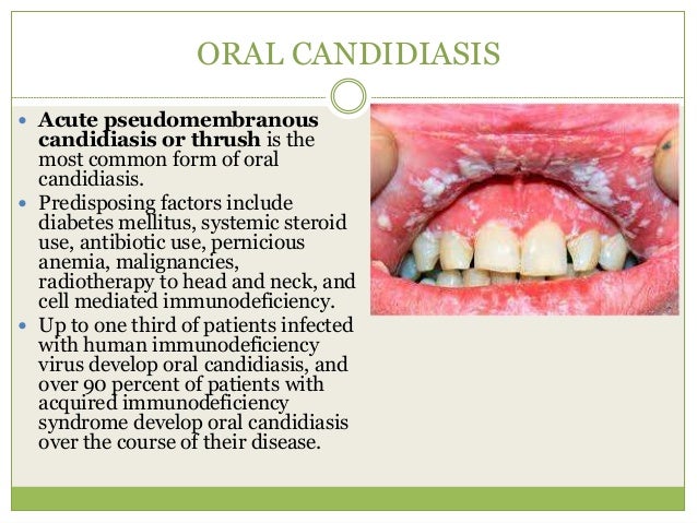 Candidiasis