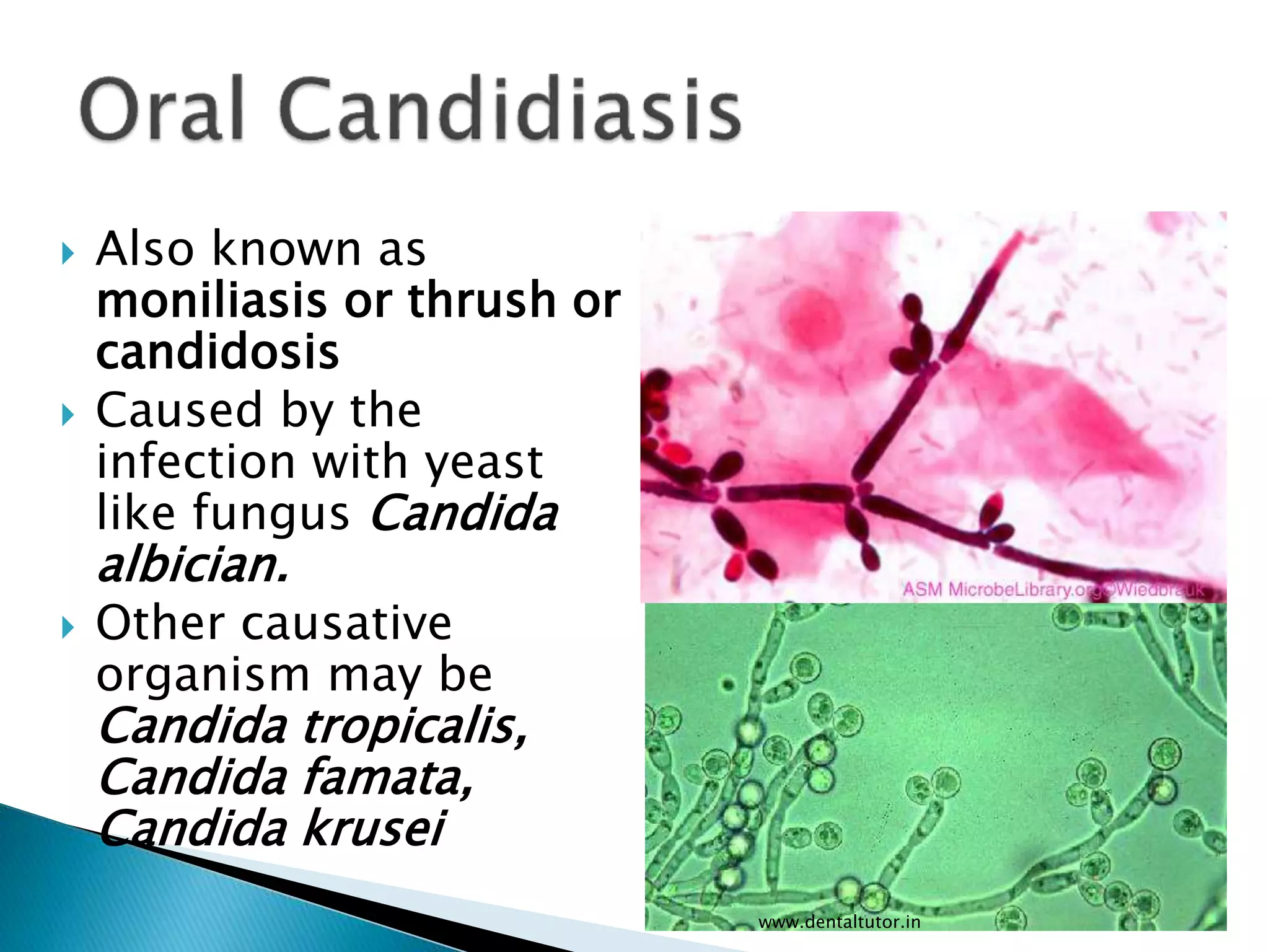 Candidiasis | PPTX