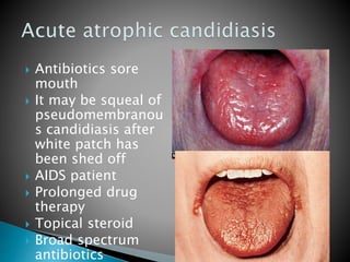Acute Atrophic Oral Candidiasis