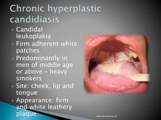 Candidal Leukoplakia