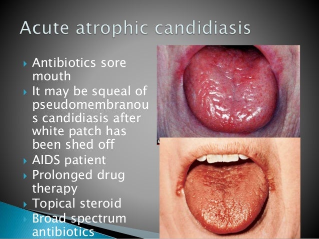 Candidiasis