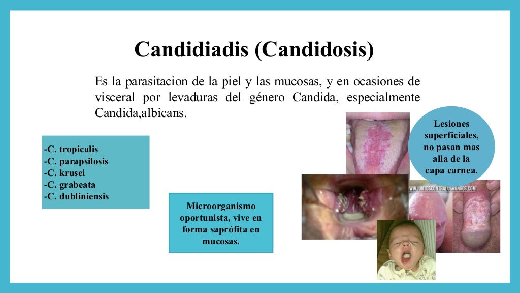 Candidiasis