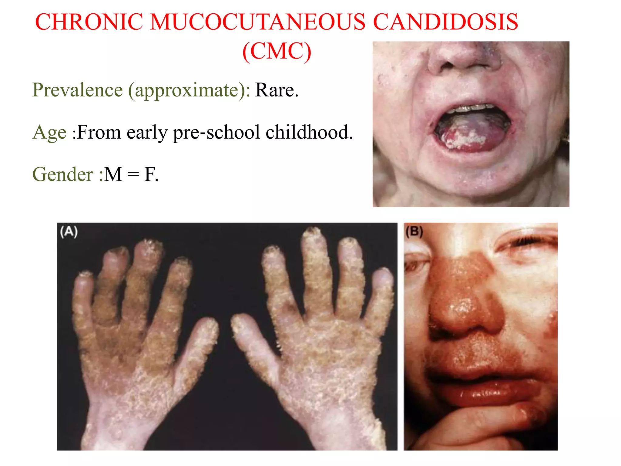 Candidiasis and its management in dentistry | PPTX