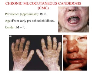 Chronic Mucocutaneous Candidiasis