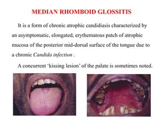 Median Rhomboid Glossitis Kissing Lesion