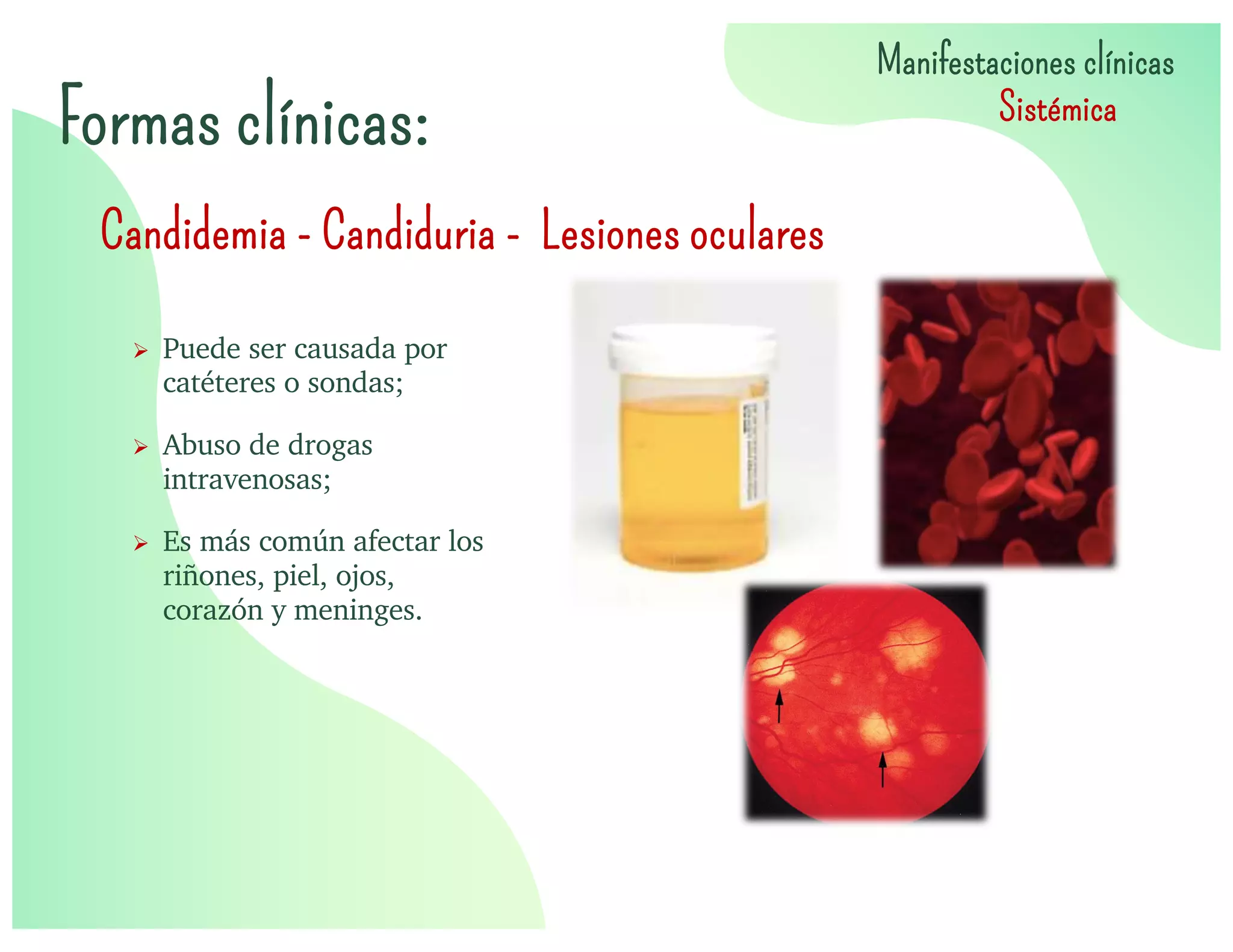 Candidiasis | PDF