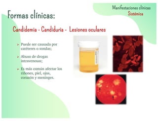 Candidiasis | PDF