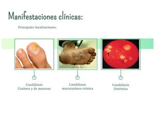 Candidiasis | PDF