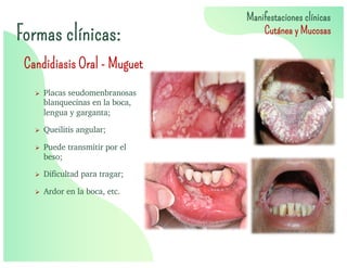 Candidiasis | PDF