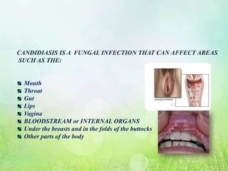 Current Developments in Prevention and Treatment of Candidiasis | PPTX