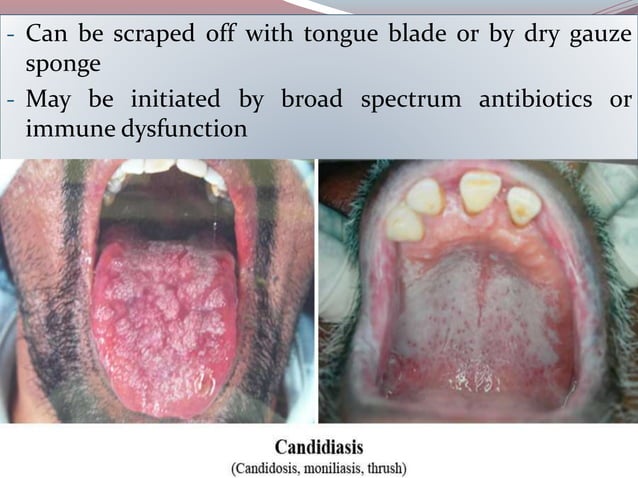 Candidiasis.pptx