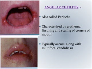 Candidiasis.pptx