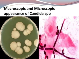Candidiasis.pptx