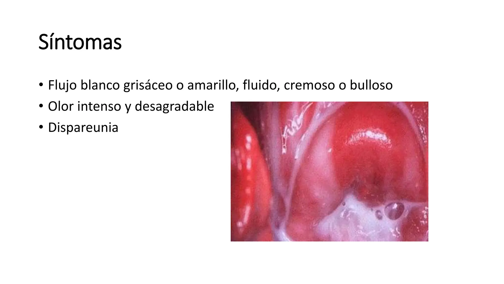 Flujos Vaginales, candidiasis, vaginosis bacteriana | PPTX
