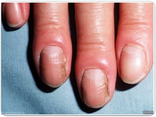 Candidiasis.pptx Azizullah Aziz Abdali university | PPT